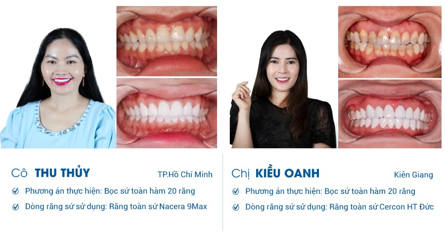 Đánh giá chất lượng làm răng sứ tại I-Dent DiamondTech