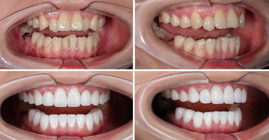 Đánh giá chất lượng làm răng sứ tại I-Dent DiamondTech