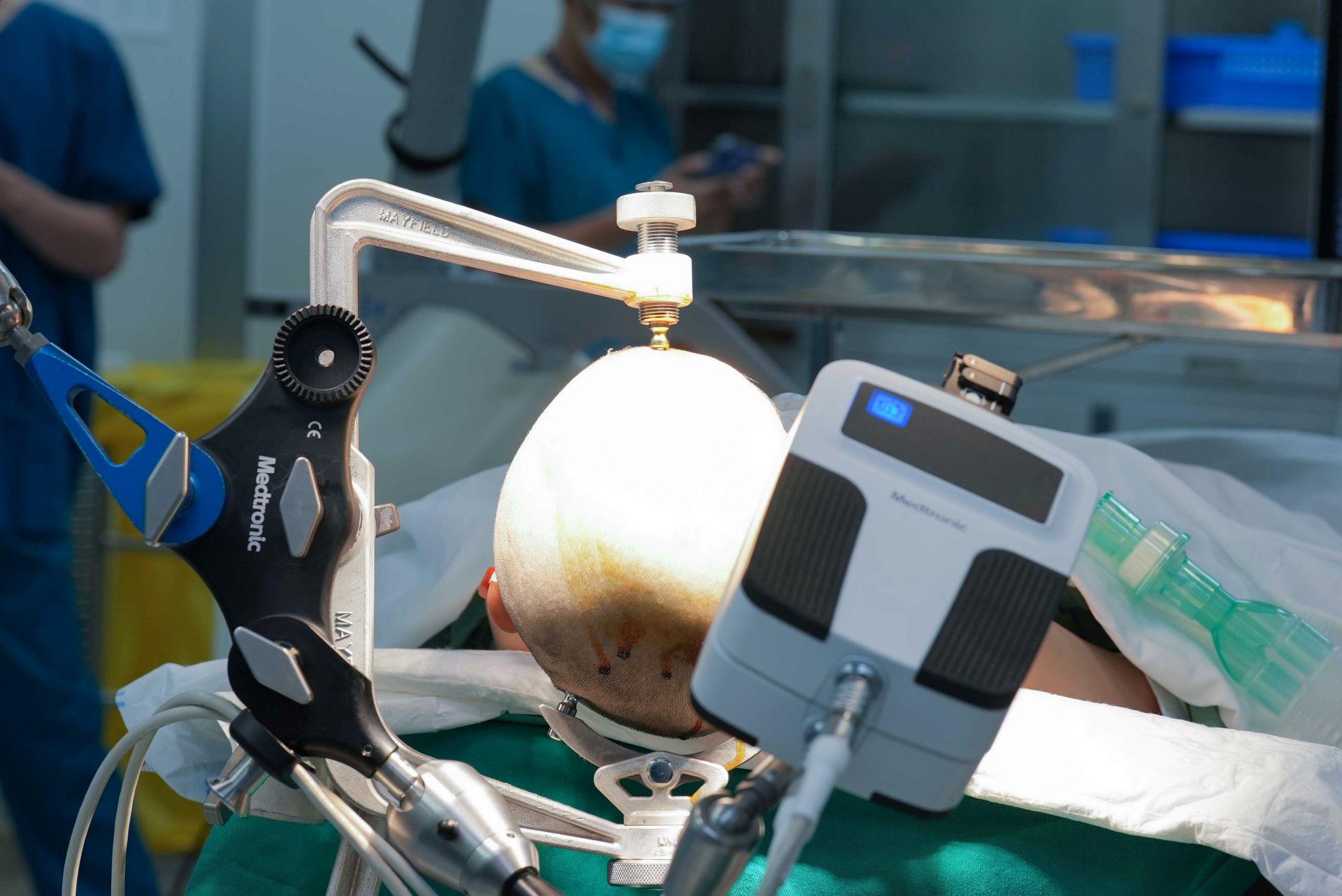 Vinmec tiên phong điều trị động kinh bằng Robot định vị thần kinh hàng ...