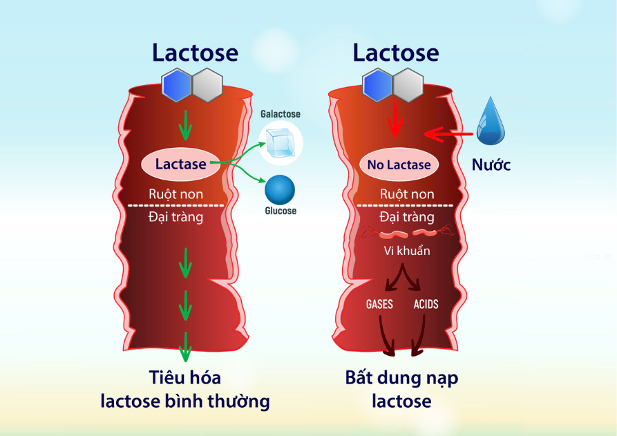 Bất dung nạp lactose Những điều cha mẹ cần biết để bảo vệ hệ tiêu hóa ...